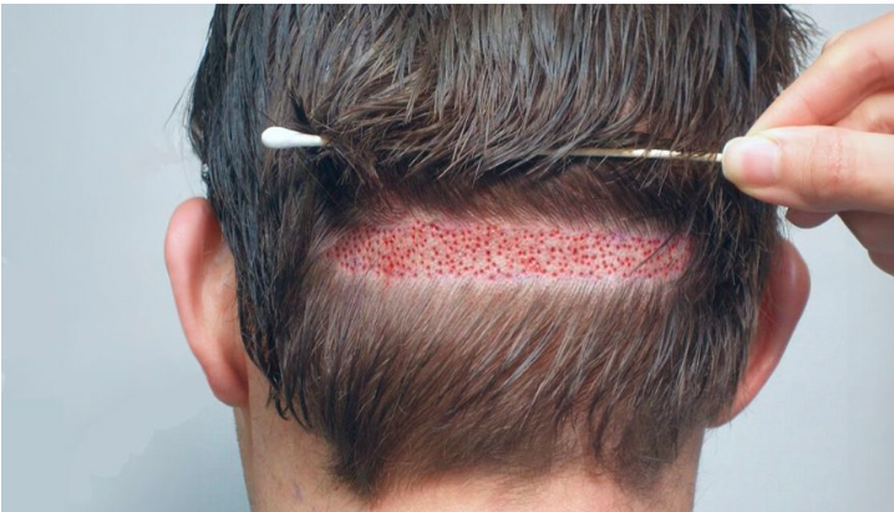 hybrid hair transplant Lnk.Bio · link in bio